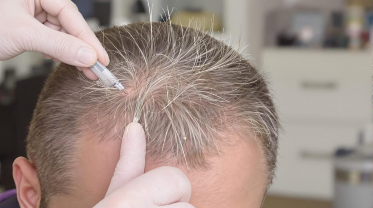Greffe de cheveux les étapes : Guide complet pour réussir votre ...